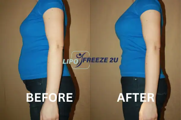 Fat Freezing Treatment Oxfordshire Non-Surgical Fat Reduction